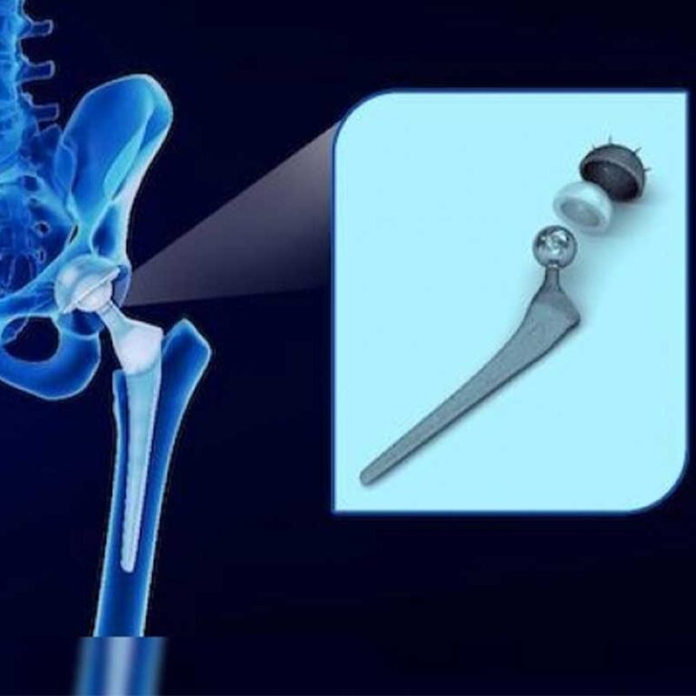 Hip Prosthesis – Mys Medicare
